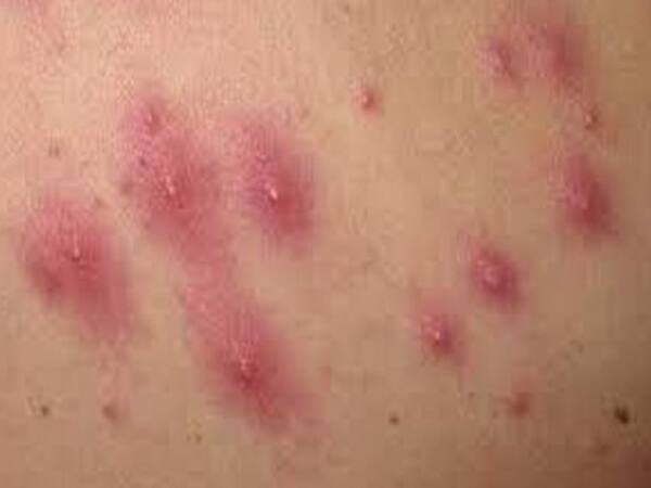 Parenting Tip: This will help your kid to get rid of boils, pimples